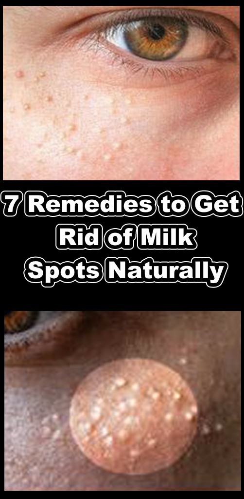 7 Remedies to Get Rid of Milk Spots Naturally