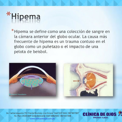 Clínica de Ojos Oftalmic Láser: Hipema