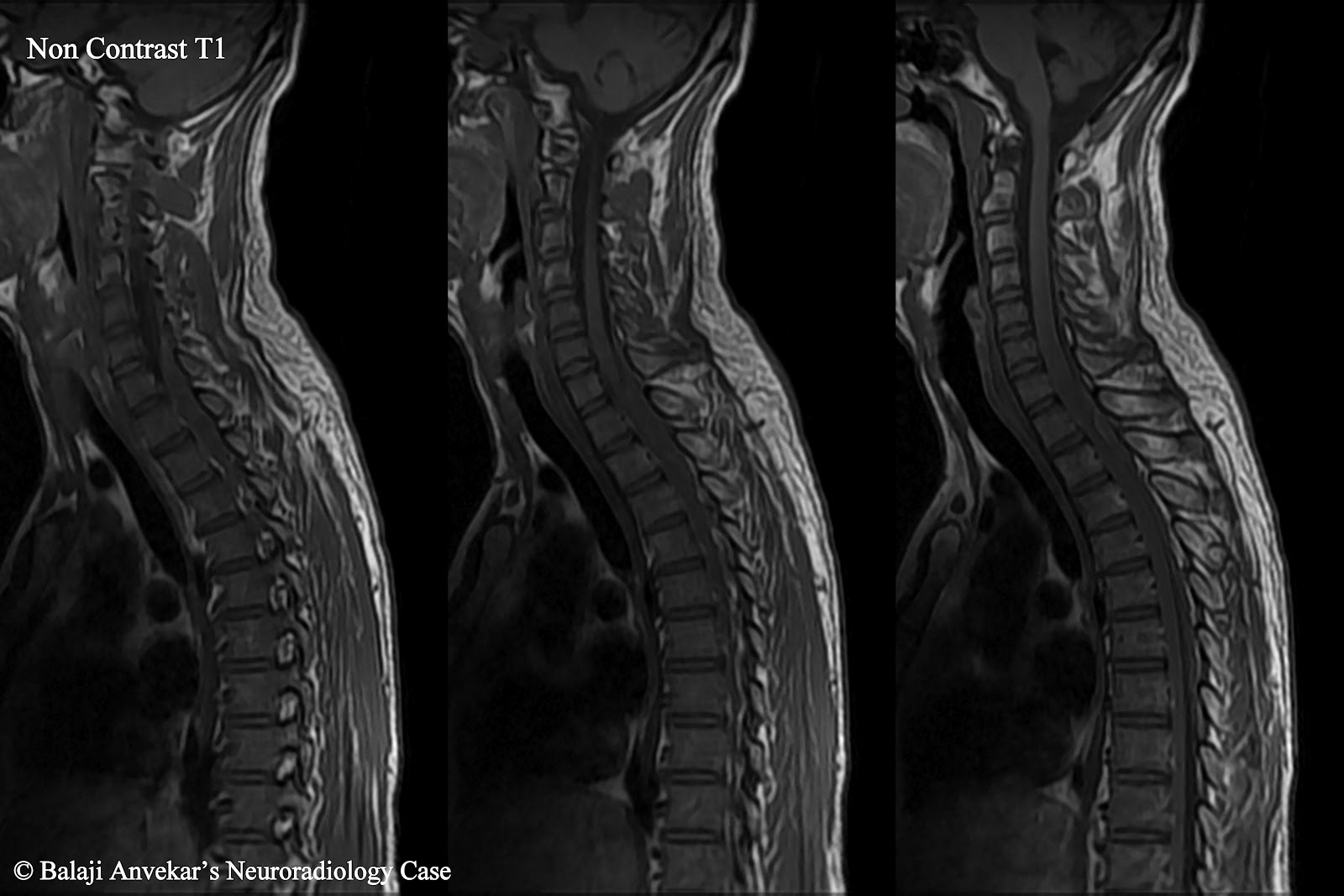 Dr Balaji Anvekar Frcr Spinal Epidural Hematoma Mri