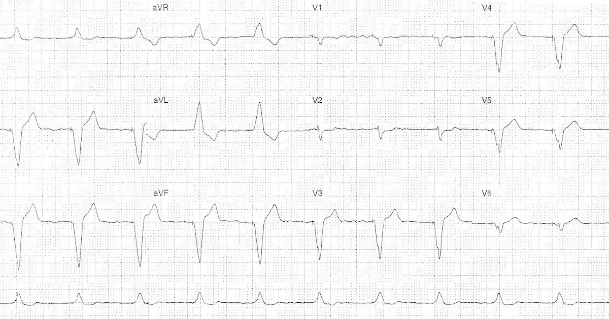 ECG of the Week: ECG of the Week - 2nd April 2018 - Interpretation