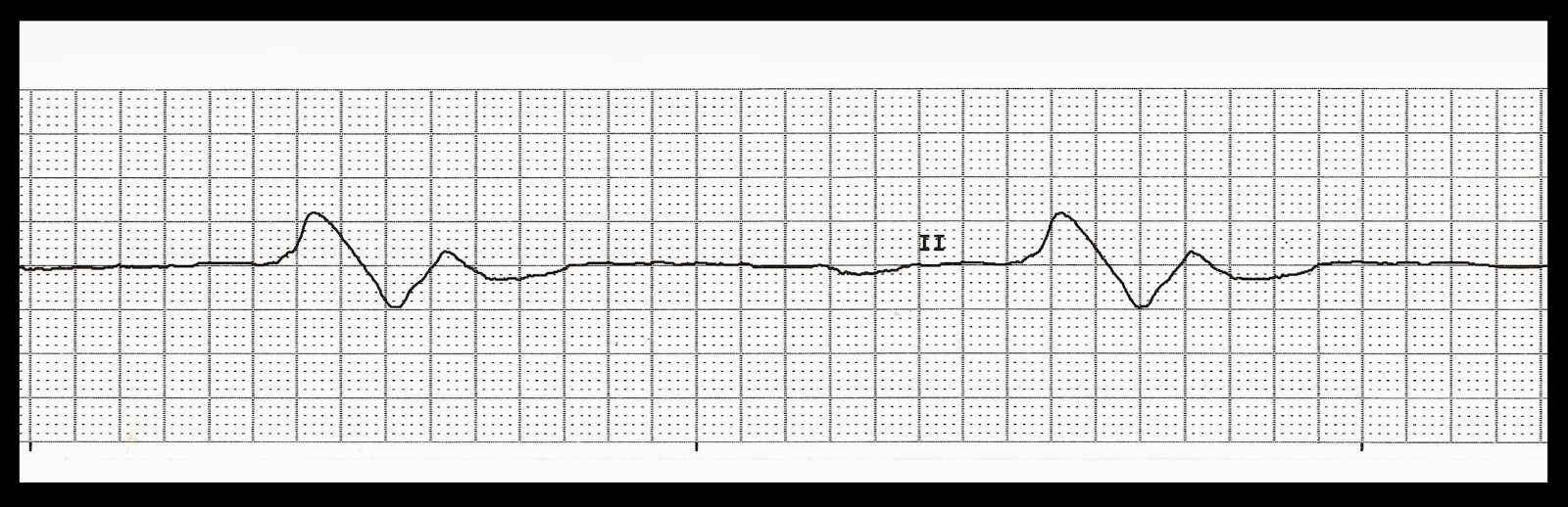 EKG Rhythm Quiz 277