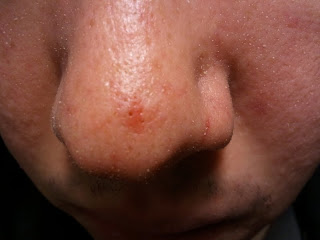 My Accutane Journal. My battle with acne at 29: Day 32 - Noticing an an ...