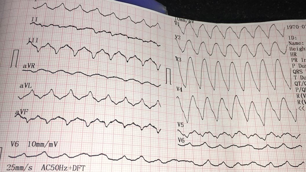 Cardiology window: ECG changes in hyperkalemia