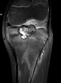 Chondroblastoma-MRI - Sumer's Radiology Blog