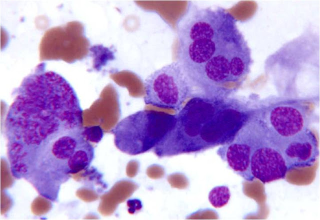 Cytology: Canine renal mass FNA | Veterinary Clinical Pathology