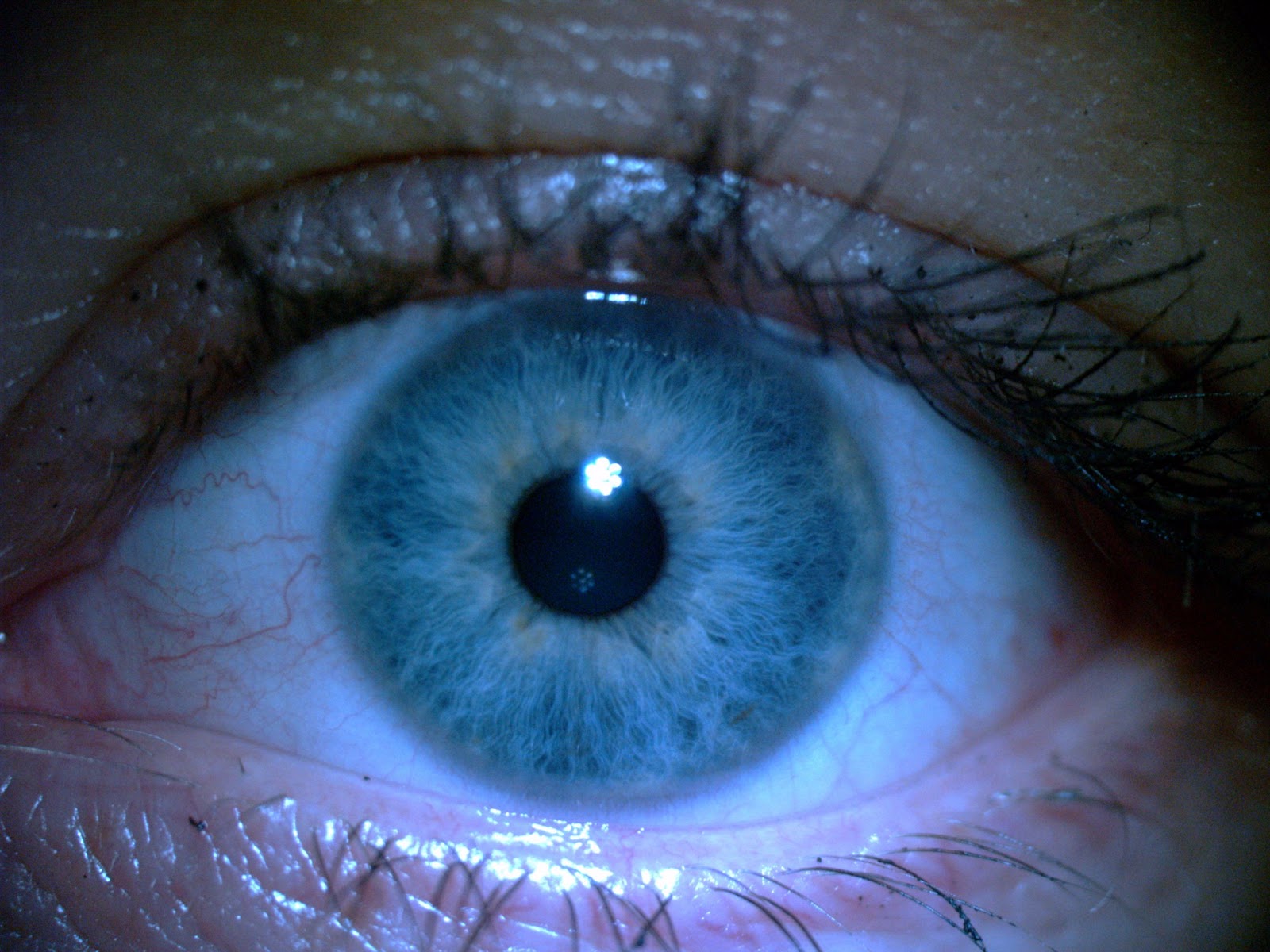 Vernon's Vision: CORNEAL ARCUS