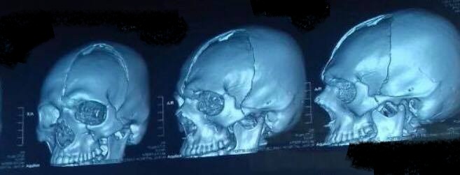 Depressed Fracture NCCT Sumer s Radiology Blog depressed-fracture-ncct-sumer-s-radiology-blog