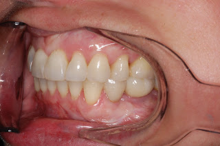 Truman Orthodontics: Narrow Smile