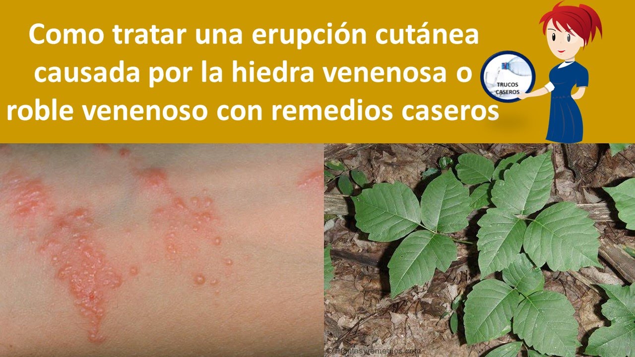 Control de Plagas en Sanidad Ambiental: Dermatitis por contacto con ...