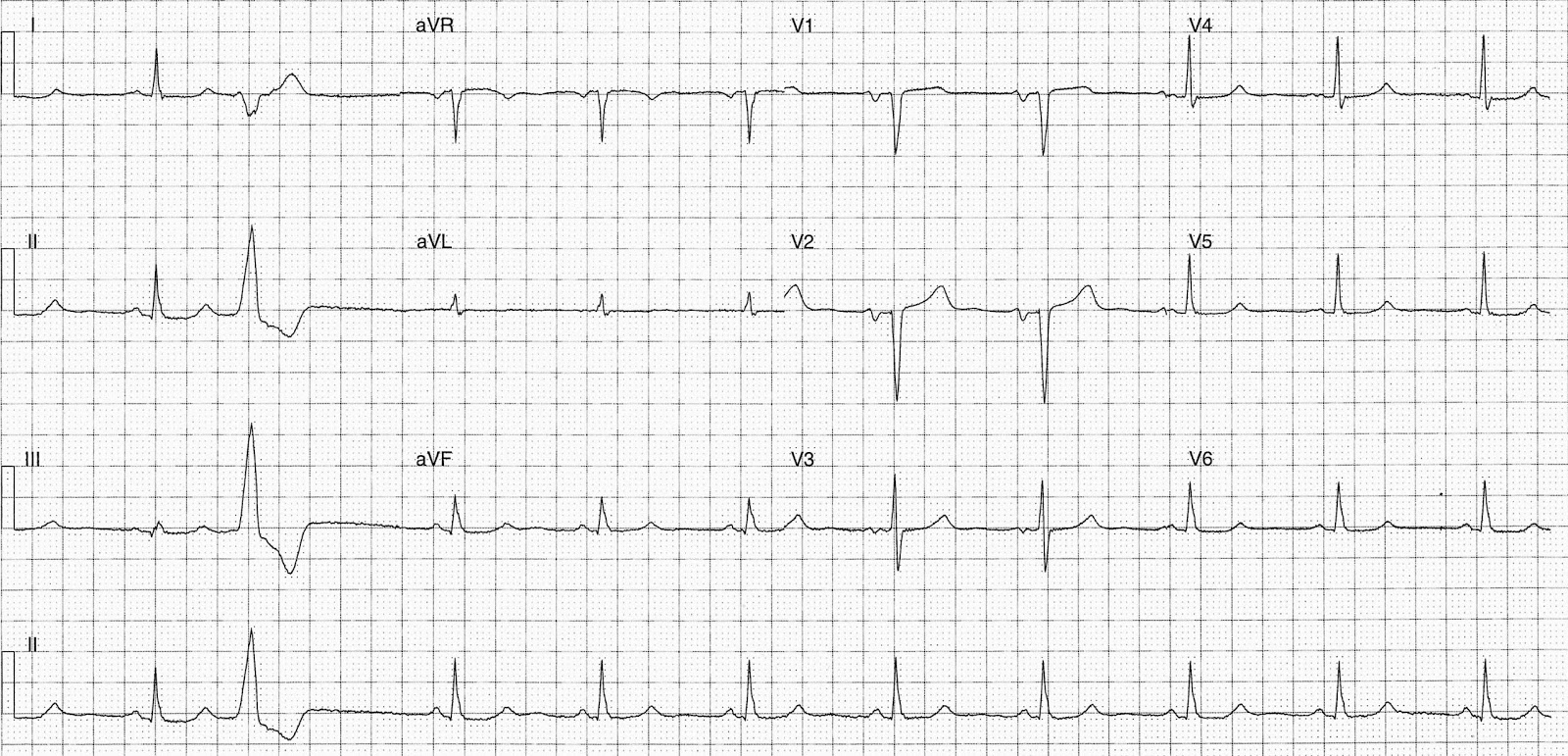 ECG of the Week: ECG of the Week - 26th June 2017 - Interpretation