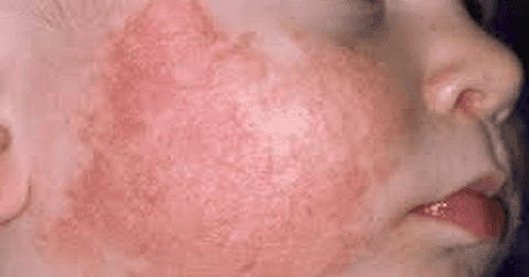 How often penile yeast infection treatment 2015! - Can yeast infections ...