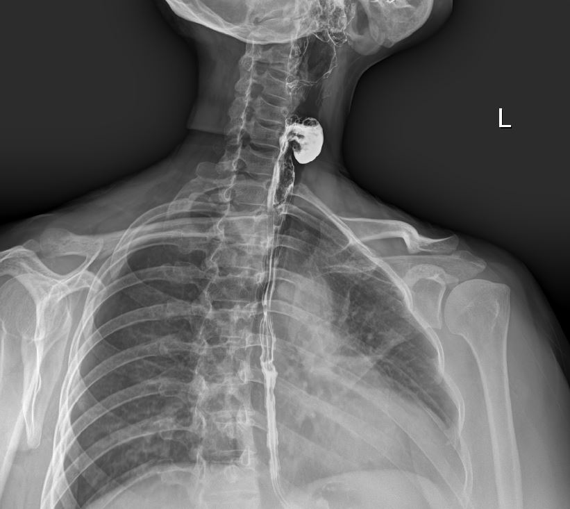 For Better Life..: 갑상선 암으로 오인된 Zenker's diverticulum