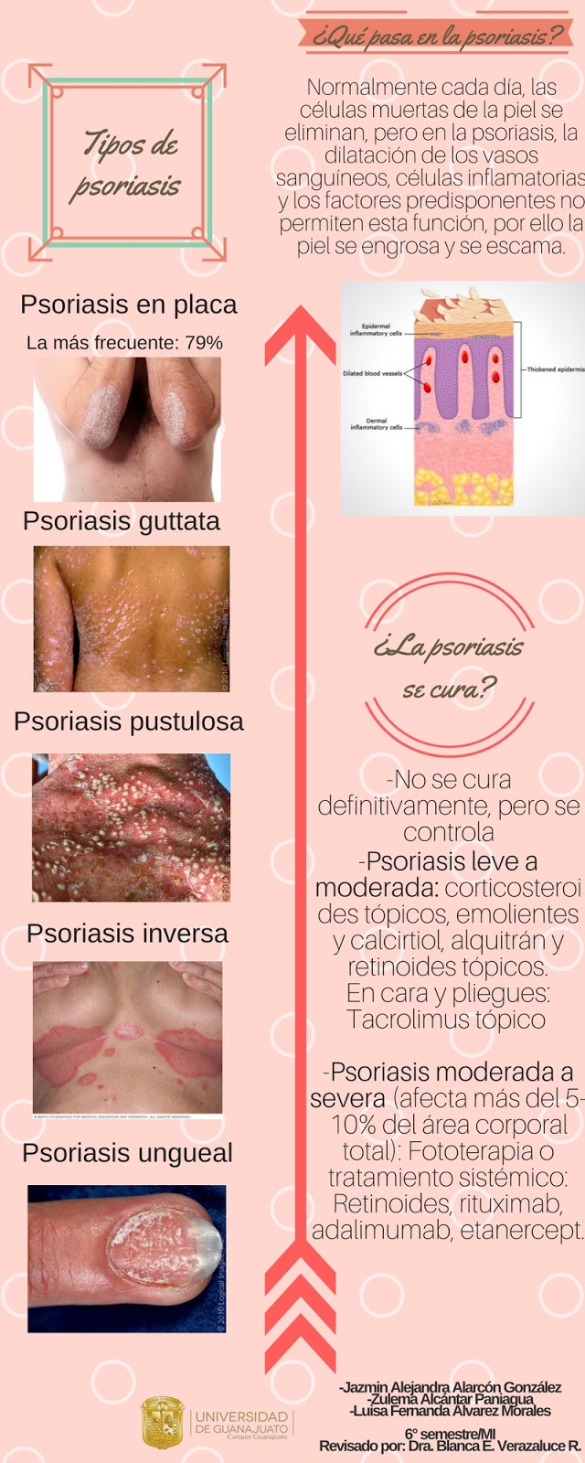 DIVULGACIÓN CIENTÍFICA UG: Tipos de Psoriasis