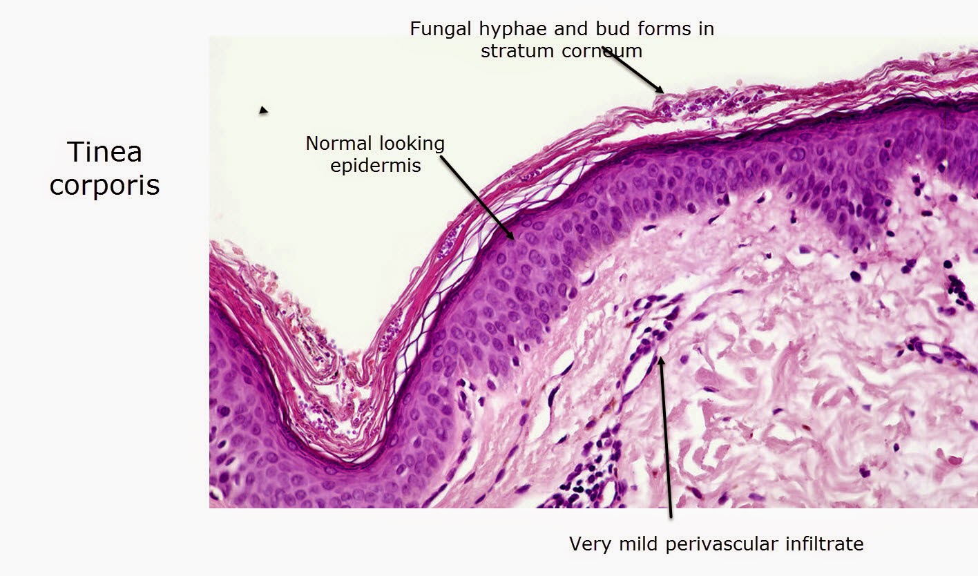 Dermatopathology Made Simple - Inflammatory: Psoriasiform Reaction Pattern