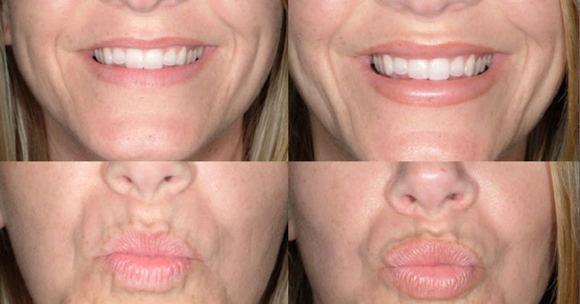 LIP AUGMENTATION: EDUCATION 101