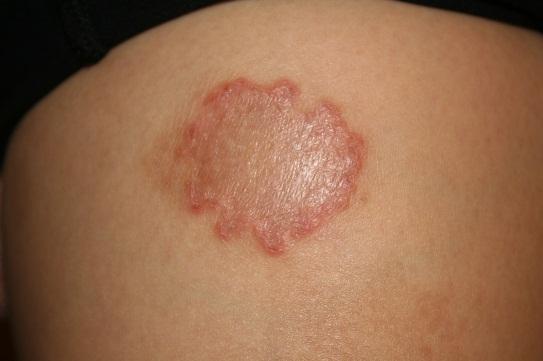 Pengertian kurap, Gejala, dan cara Pengobatannya - Berbagi Tips