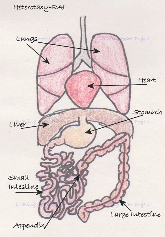 Drawing Heart: Heterotaxy RAI vs LAI