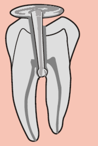 Errors in Access Cavity Preparation - Endodontics and Oral Implantology