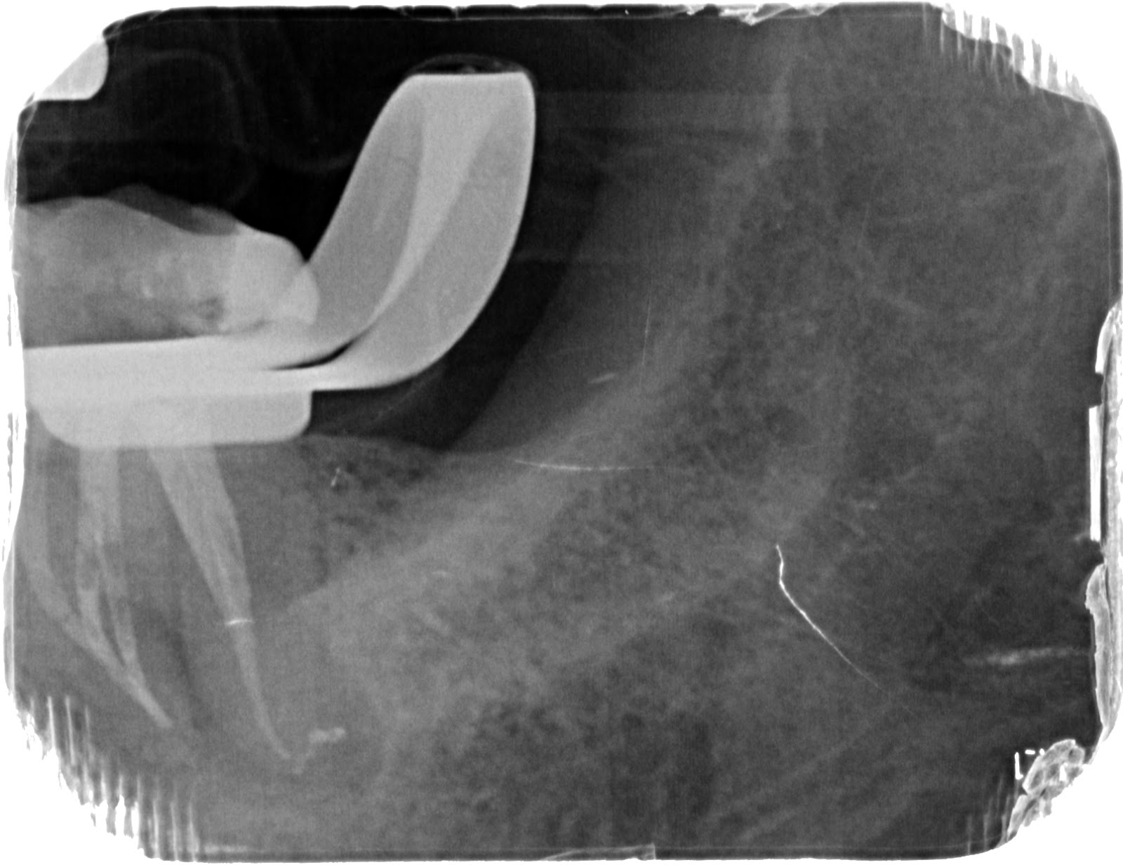 Caso clínico Master: el molar atípico