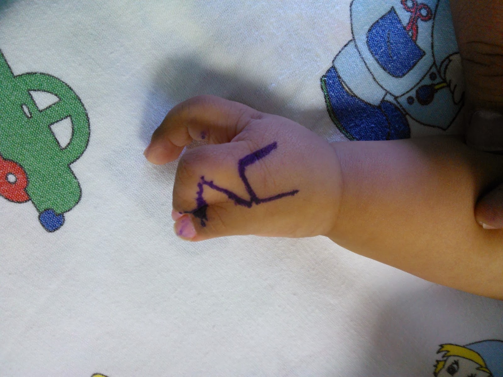 Cirugía de Mano y Traumatología: Sindactilia completa simple de primer ...