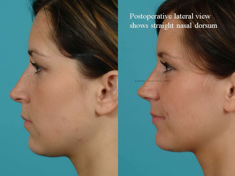 Dr. Dean Toriumi Reviews: Dean Toriumi Reviews: Severely deviated nose ...