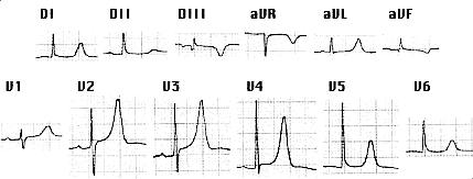 ELECTROCARDIOGRAFÍA BÁSICA PARA ENFERMERÍA: ISQUEMIA-INFARTO