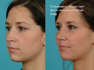 Dr. Dean Toriumi Reviews: Dean Toriumi Reviews: Severely deviated nose ...