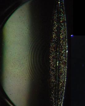 All things eye | Por Yong Ming: An overview of cataract surgery lens ...