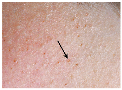 Jerawat: Penyebab dan Proses Terjadinya