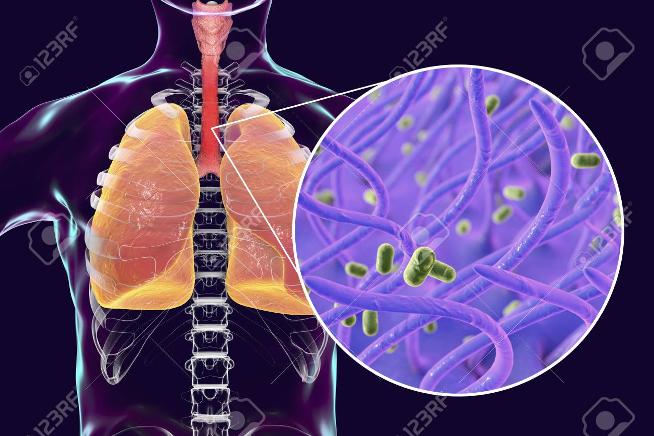 TOS FERINA Vs SÍNDROME DE COQUELUCHOIDE