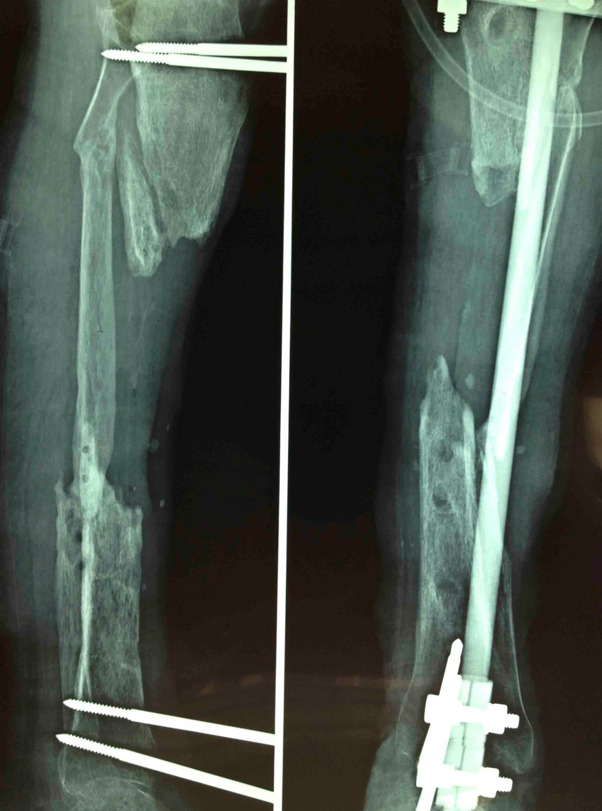 O R T O C R I T I C A: FRACASO DE INJERTO DIAFISIARIO TIBIAL