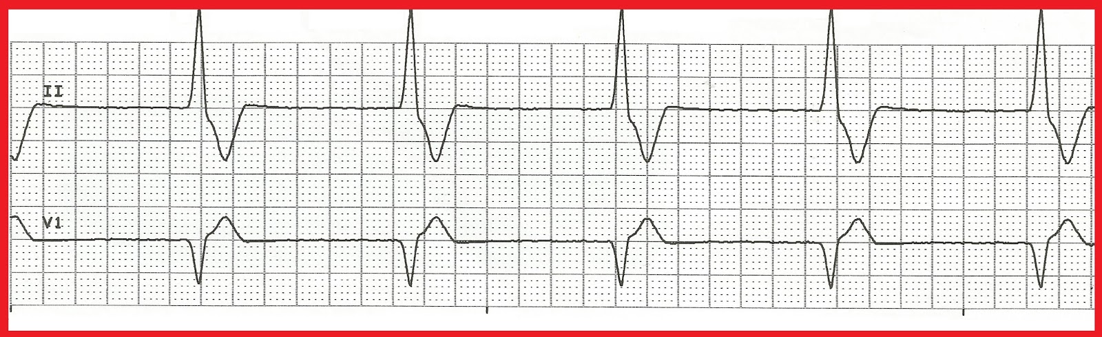 EKG Rhythm Strip Quiz 162