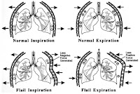 Tórax inestable | El Blog De La Enfermera