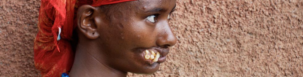 Orthodox Christian Initiative for Africa: Noma (cancrum oris), the ...