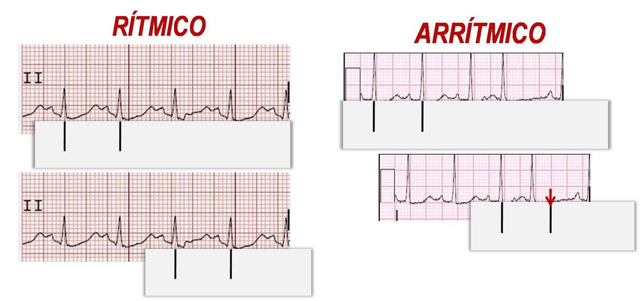 Tutomedic: RUTINA DE INTERPRETACIÓN DEL ECG:2- Ritmo