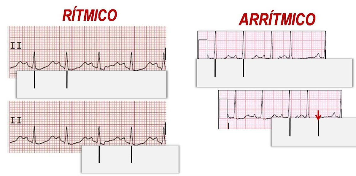 Tutomedic: RUTINA DE INTERPRETACIÓN DEL ECG:2- Ritmo