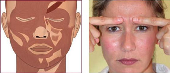 Gimnasia Facial: Músculo superciliar