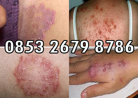 Perbedaan Panu Kadas Kudis Kurap | Tips Sehat Tanpa Obat