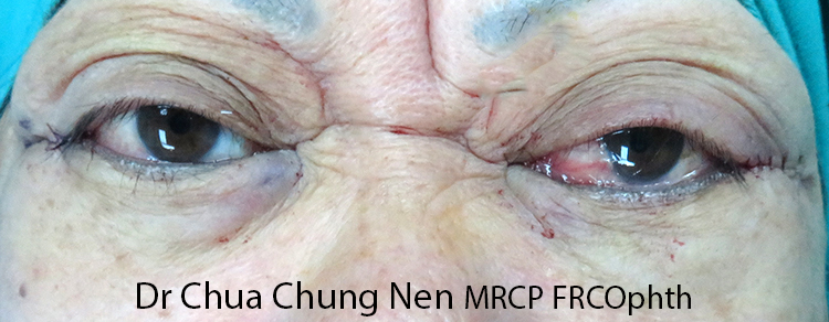 Eyelid Surgery by Prof Dr CN CHUA 蔡鐘能: A hyperthyorid patient with eye ...