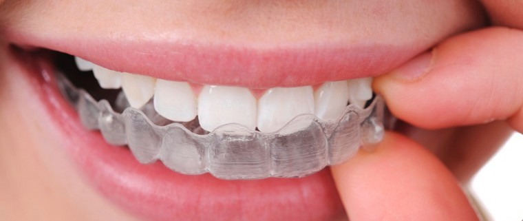 Guarda Oclusal - Clínica Dental Arauz