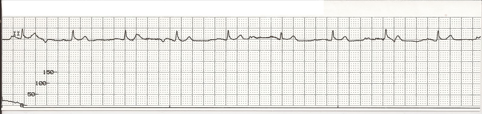 Various rhythms with arterial blood pressure waveform