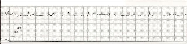 Various rhythms with arterial blood pressure waveform