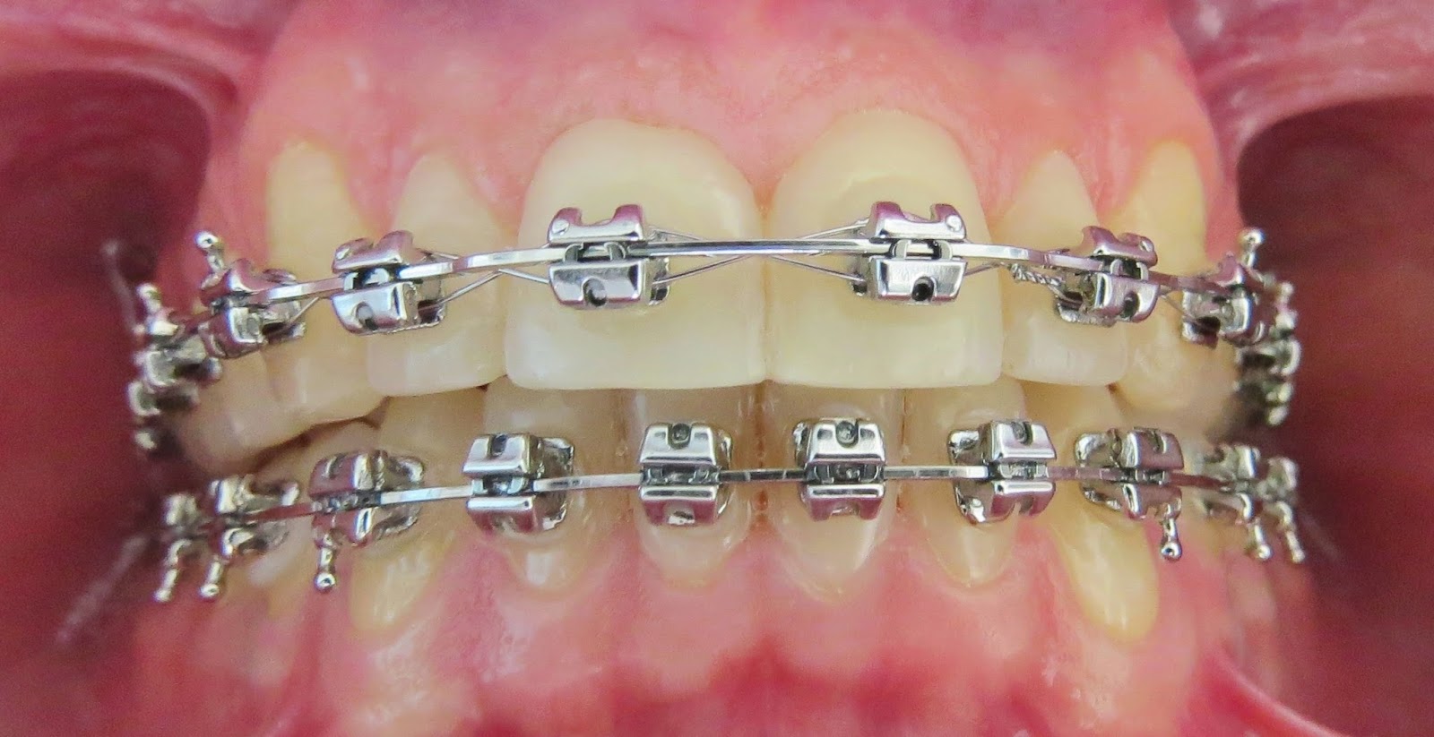 Ortodontia.com.Borel: Aparelho Estético ou Metálico? (Tipos de Aparelhos)