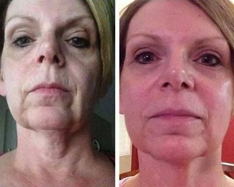 Fill Out And Expand Sunken Cheeks With Facial Aerobics Exercises