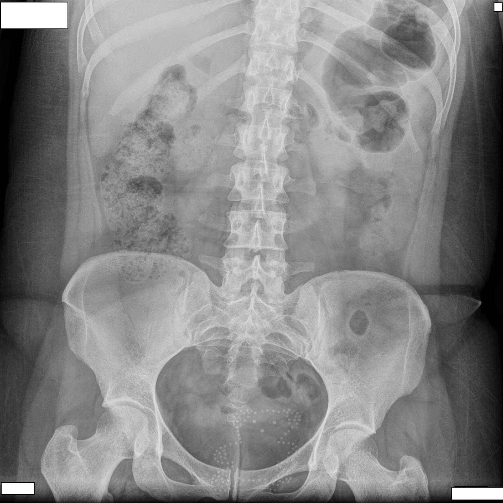 la radiografía de abdomen