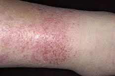 What is Stasis Dermatitis and how to treat it | Get Rid Of Eczema Now