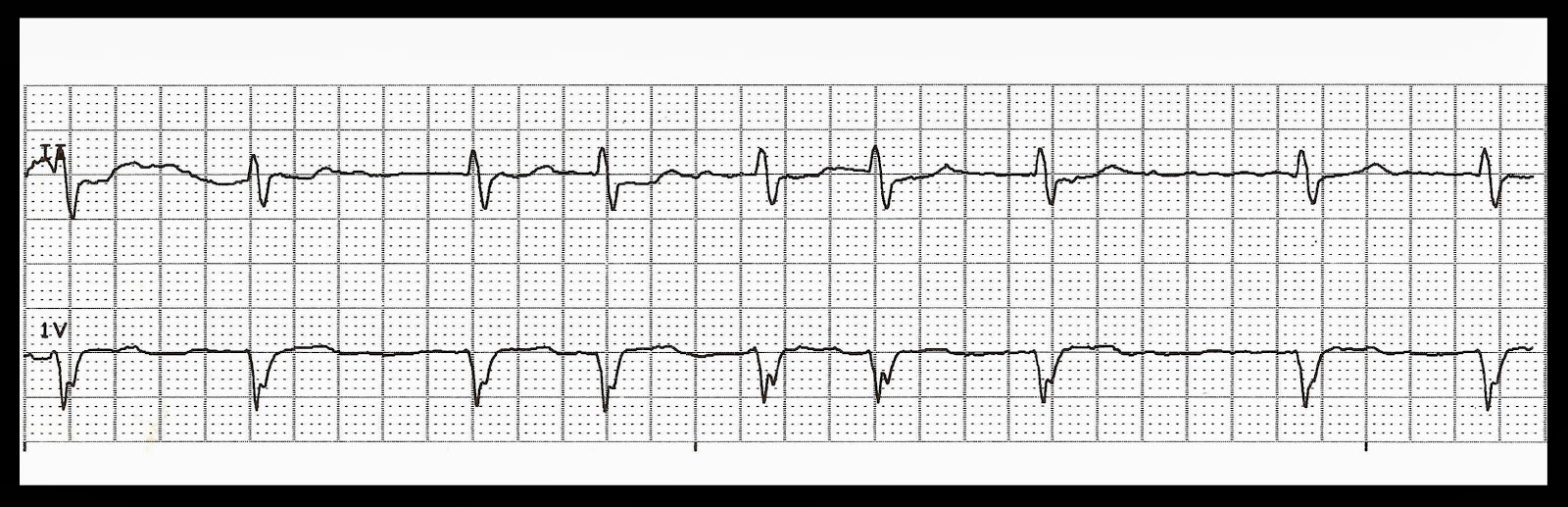 Various Atrial Fibrillations