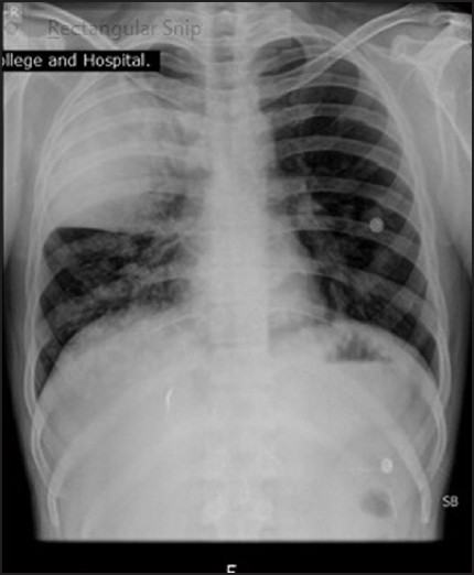 Chest Medicine Made Easy-Dr Deepu: signs in chest radiology Bulging ...
