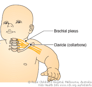 Brachial plexus injury in newborns With Image