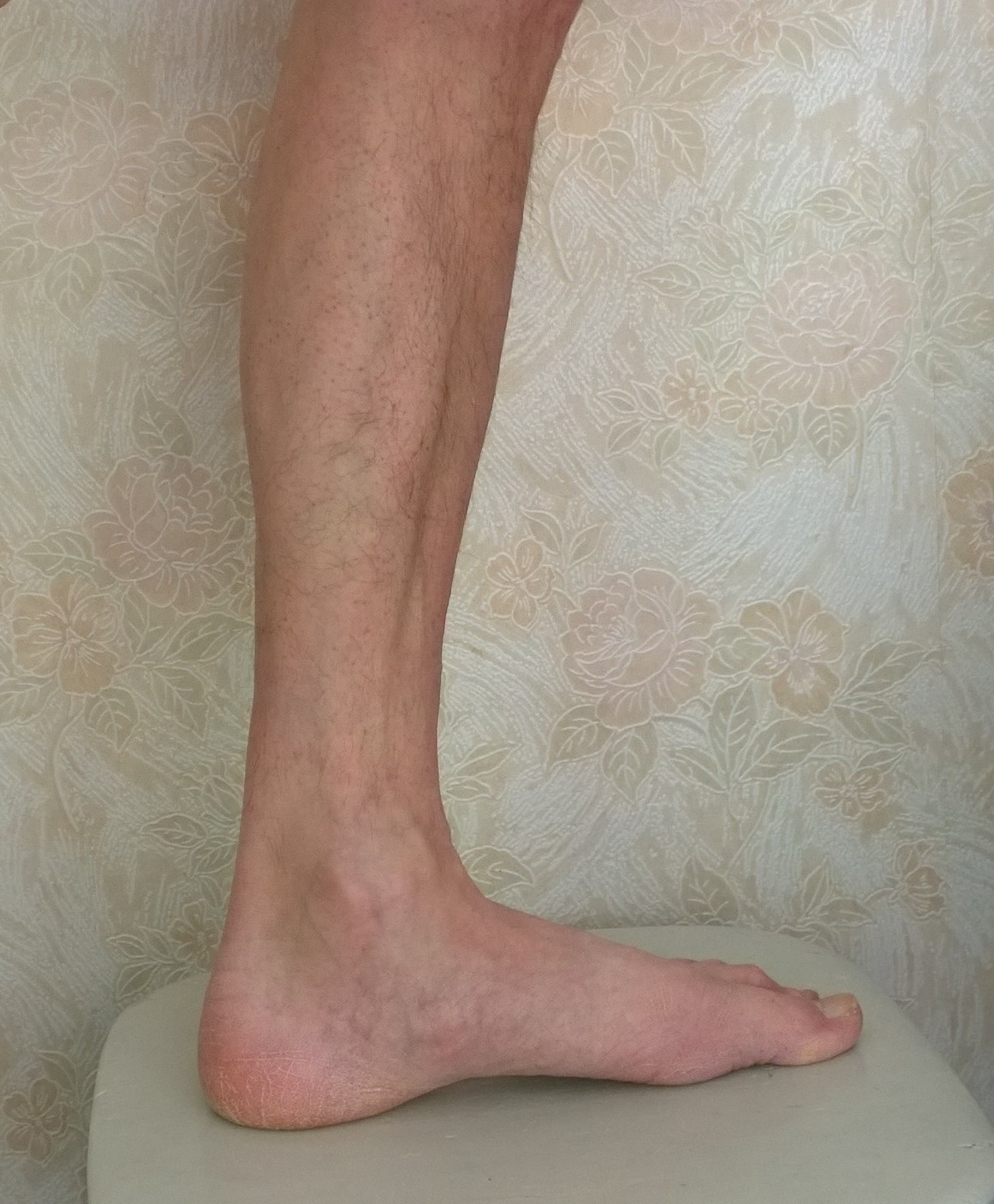 Kauneus blogi: JALKOJEN RAKENNEANALYYSI MIES 53V.